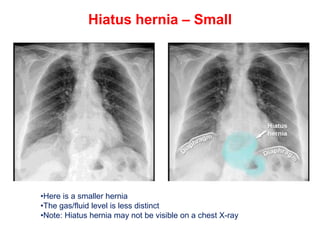 CHEST X-RAY MEDIASTINUM AND HILUMpptx.pptx