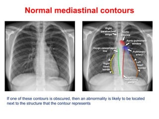 CHEST X-RAY MEDIASTINUM AND HILUMpptx.pptx