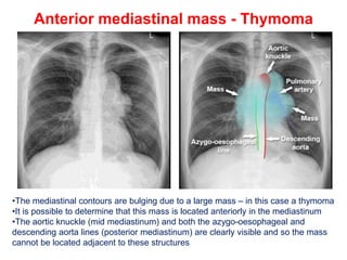 CHEST X-RAY MEDIASTINUM AND HILUMpptx.pptx