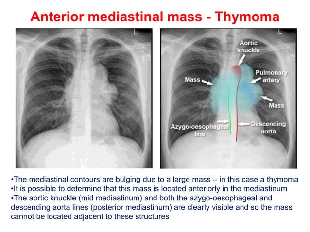CHEST X-RAY MEDIASTINUM AND HILUMpptx.pptx | Lung and Respiratory ...
