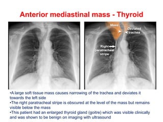 CHEST X-RAY MEDIASTINUM AND HILUMpptx.pptx