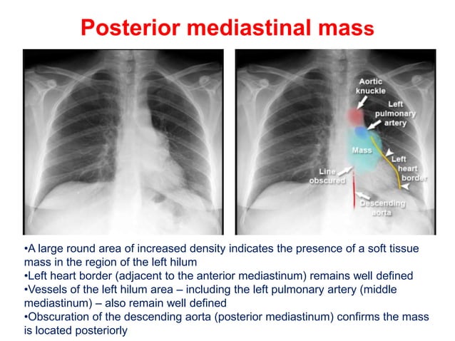 CHEST X-RAY MEDIASTINUM AND HILUMpptx.pptx | Lung and Respiratory ...