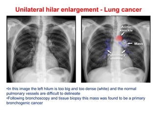 CHEST X-RAY MEDIASTINUM AND HILUMpptx.pptx
