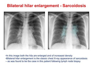 CHEST X-RAY MEDIASTINUM AND HILUMpptx.pptx