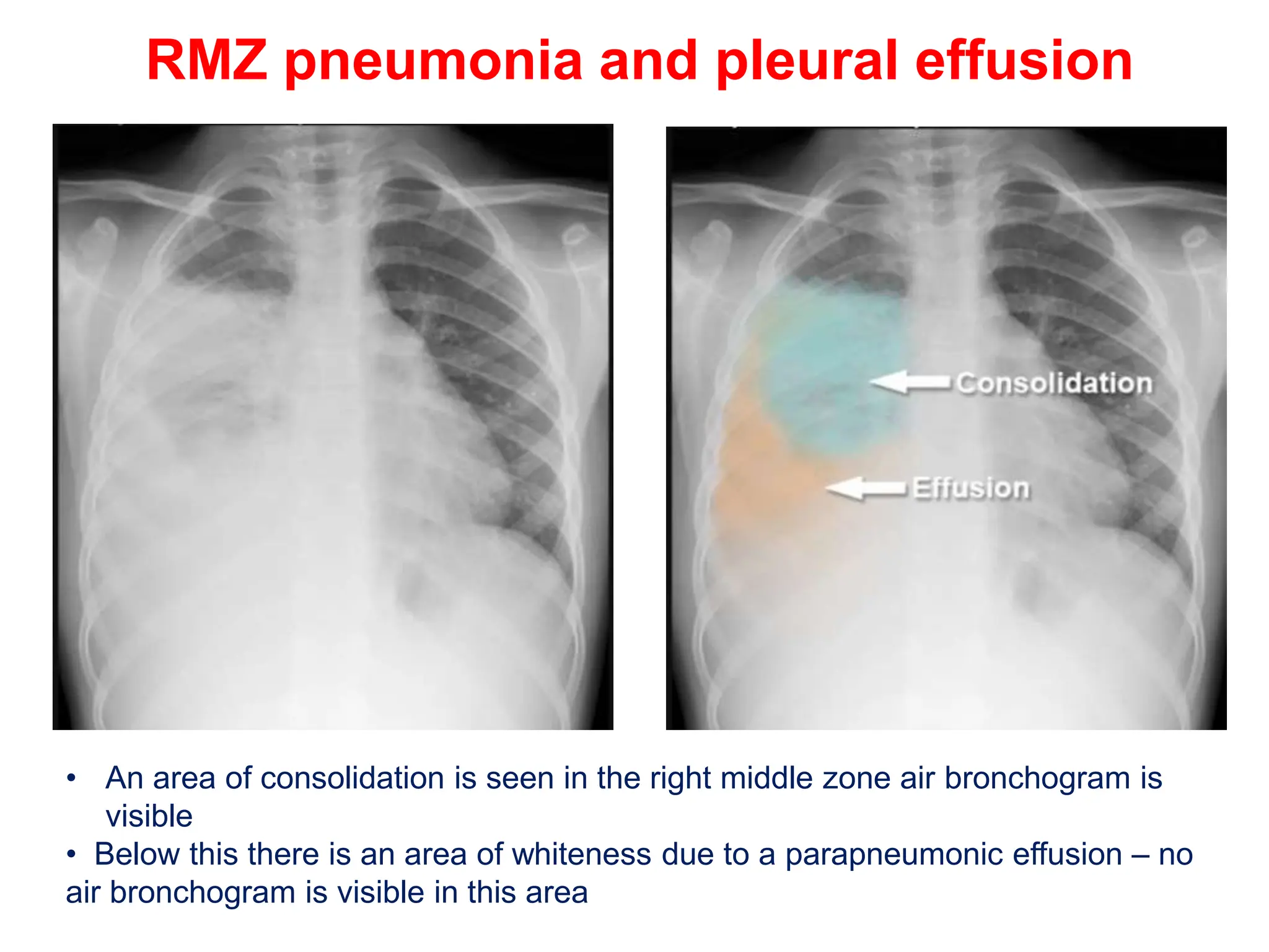 CHEST X-RAY PULMONARY DISEASE pptx.pptx