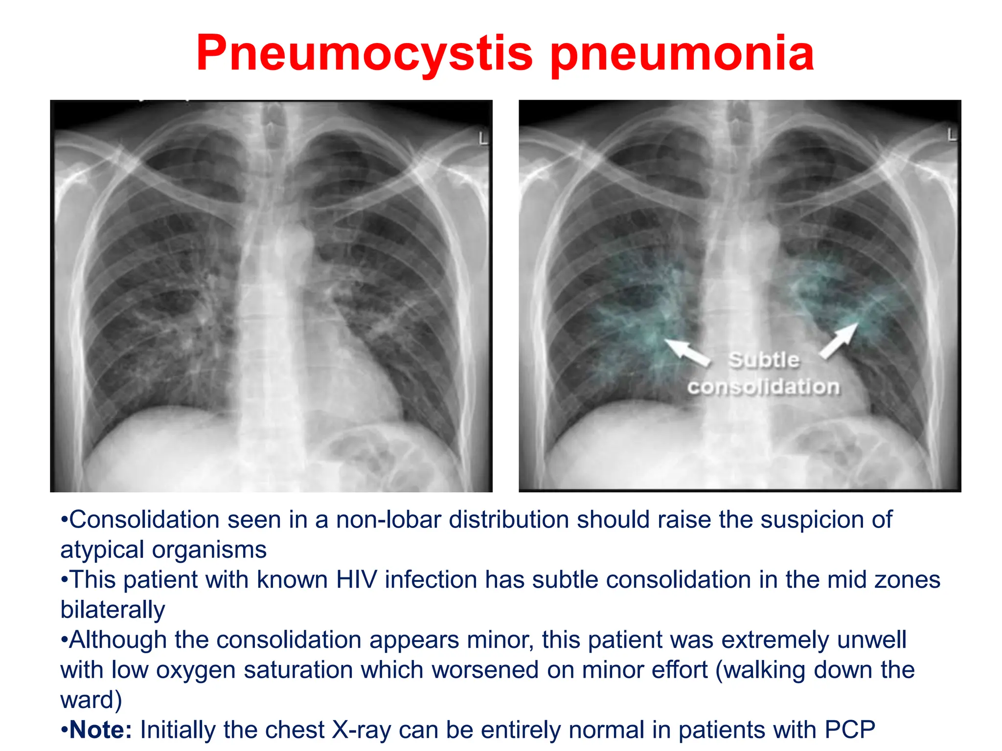CHEST X-RAY PULMONARY DISEASE pptx.pptx