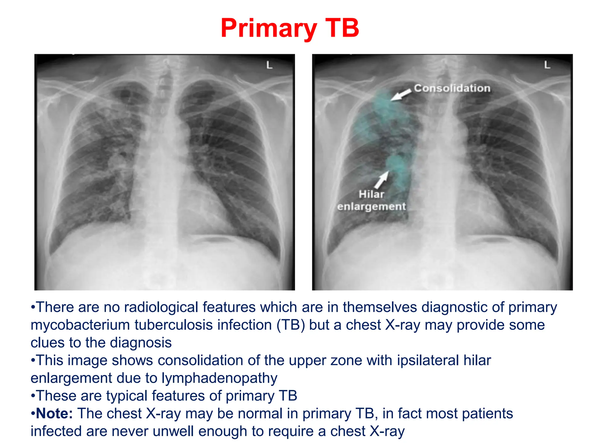 CHEST X-RAY PULMONARY DISEASE pptx.pptx