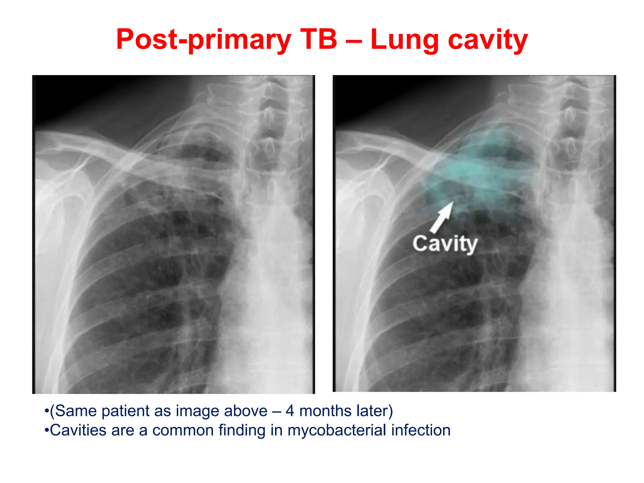 CHEST X-RAY PULMONARY DISEASE pptx.pptx