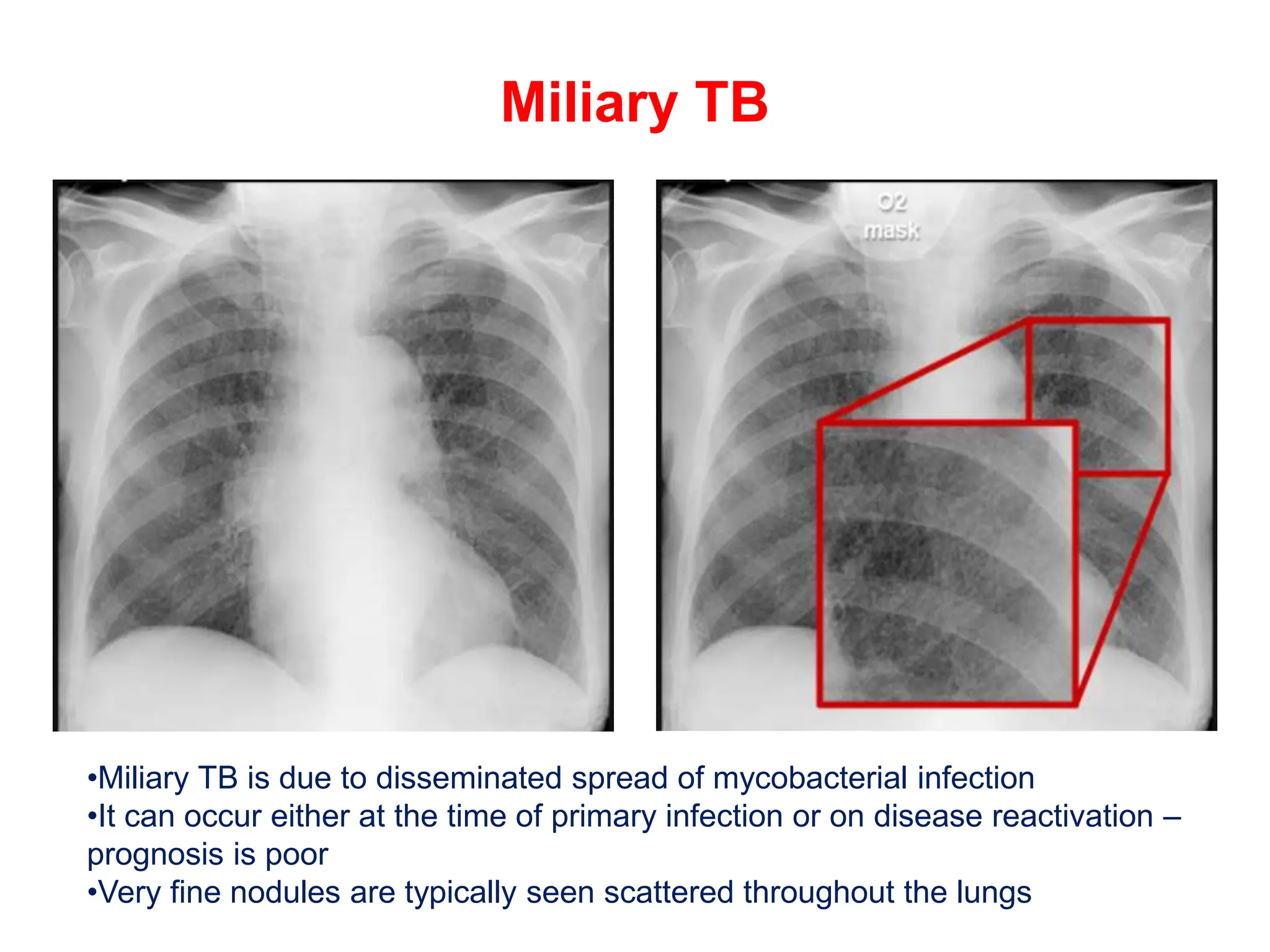 CHEST X-RAY PULMONARY DISEASE pptx.pptx