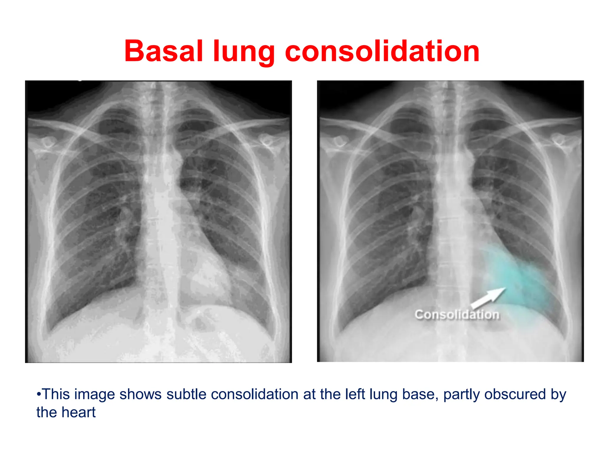 CHEST X-RAY PULMONARY DISEASE pptx.pptx