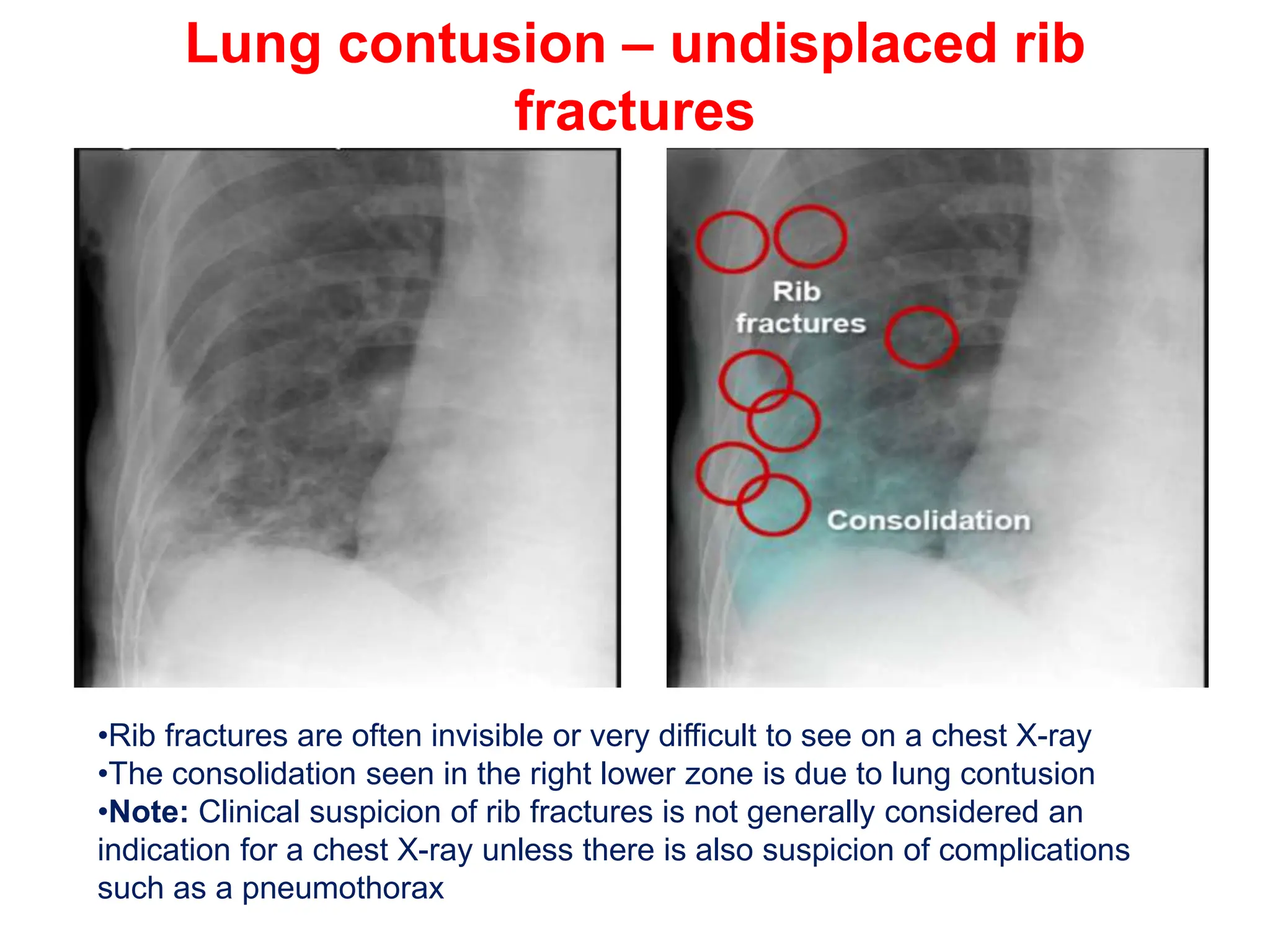 CHEST X-RAY PULMONARY DISEASE pptx.pptx