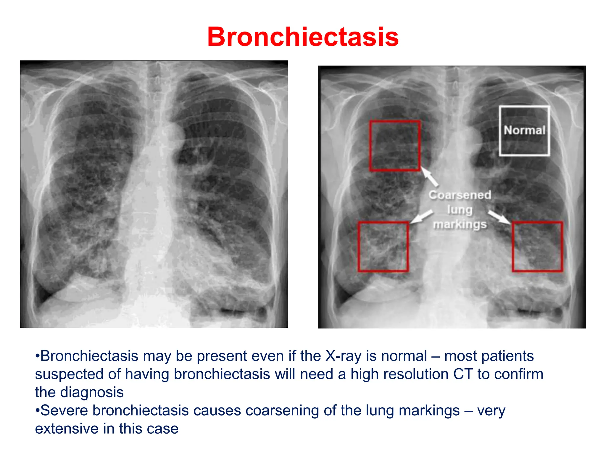 CHEST X-RAY PULMONARY DISEASE pptx.pptx
