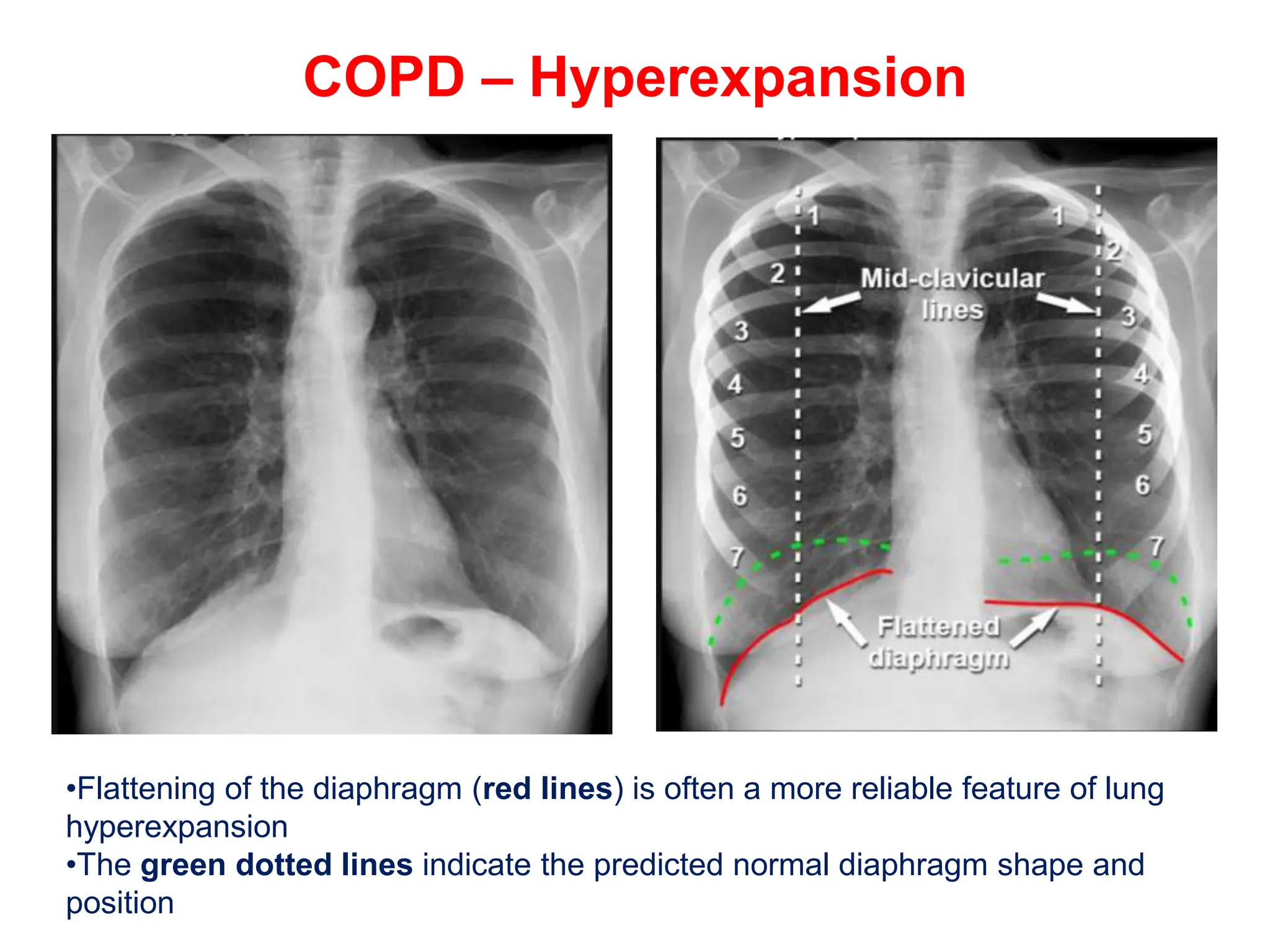 CHEST X-RAY PULMONARY DISEASE pptx.pptx
