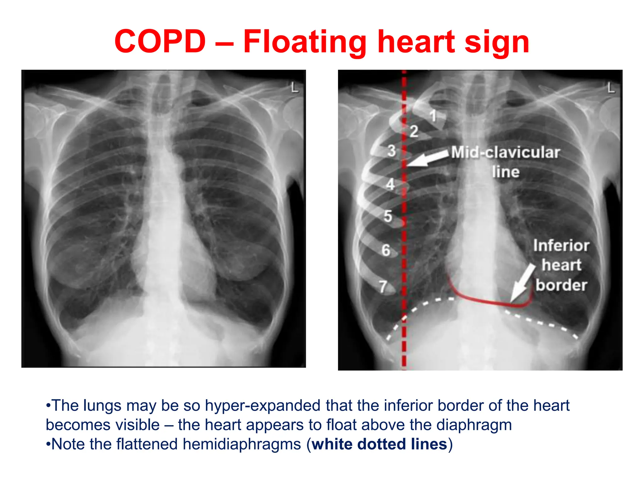 CHEST X-RAY PULMONARY DISEASE pptx.pptx
