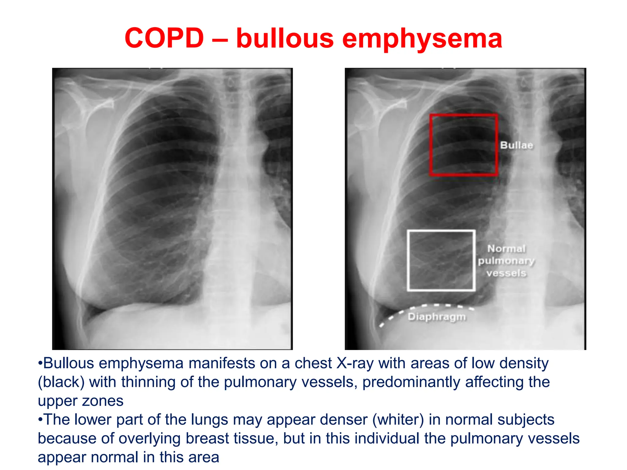 CHEST X-RAY PULMONARY DISEASE pptx.pptx