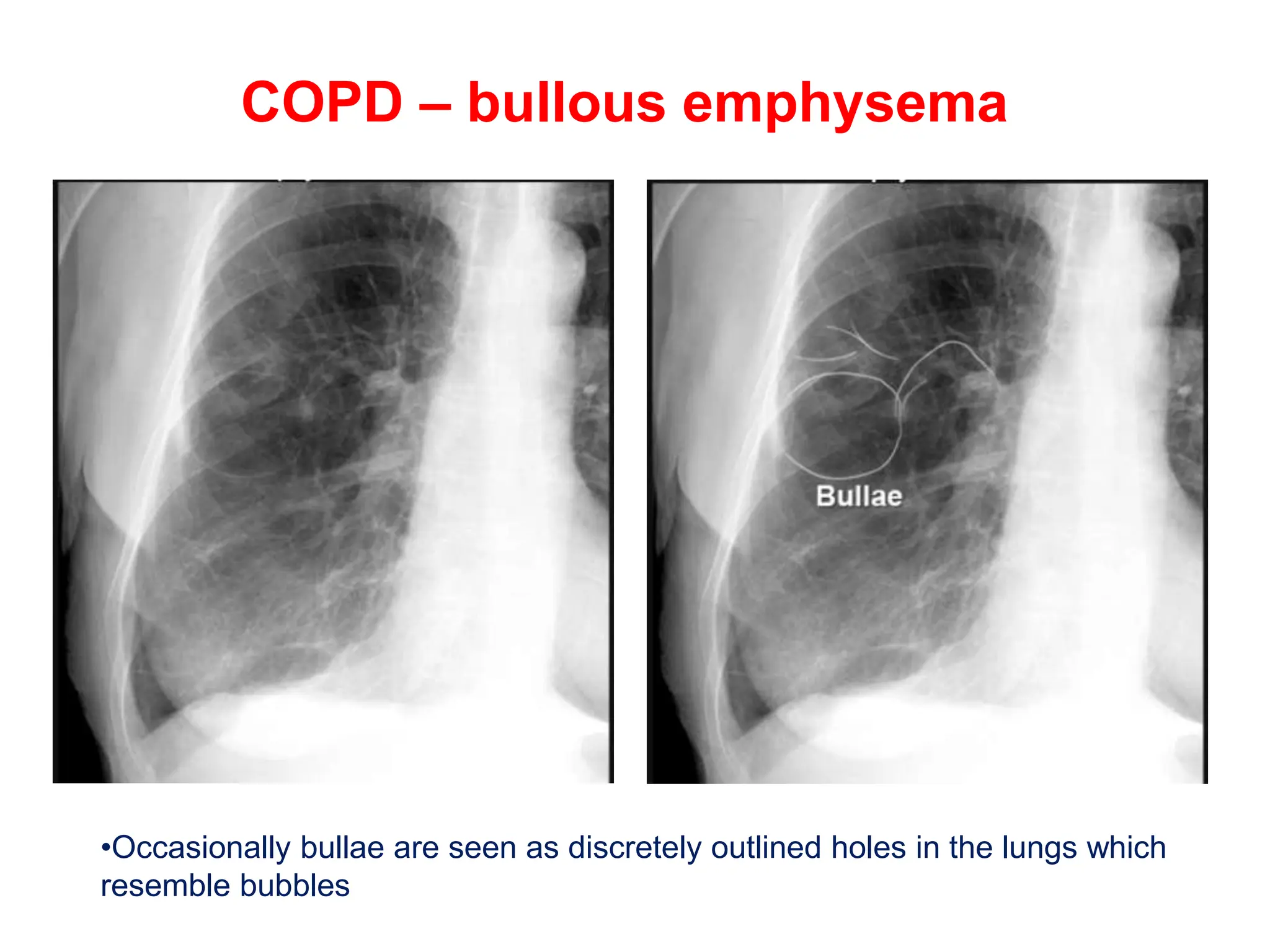 CHEST X-RAY PULMONARY DISEASE pptx.pptx