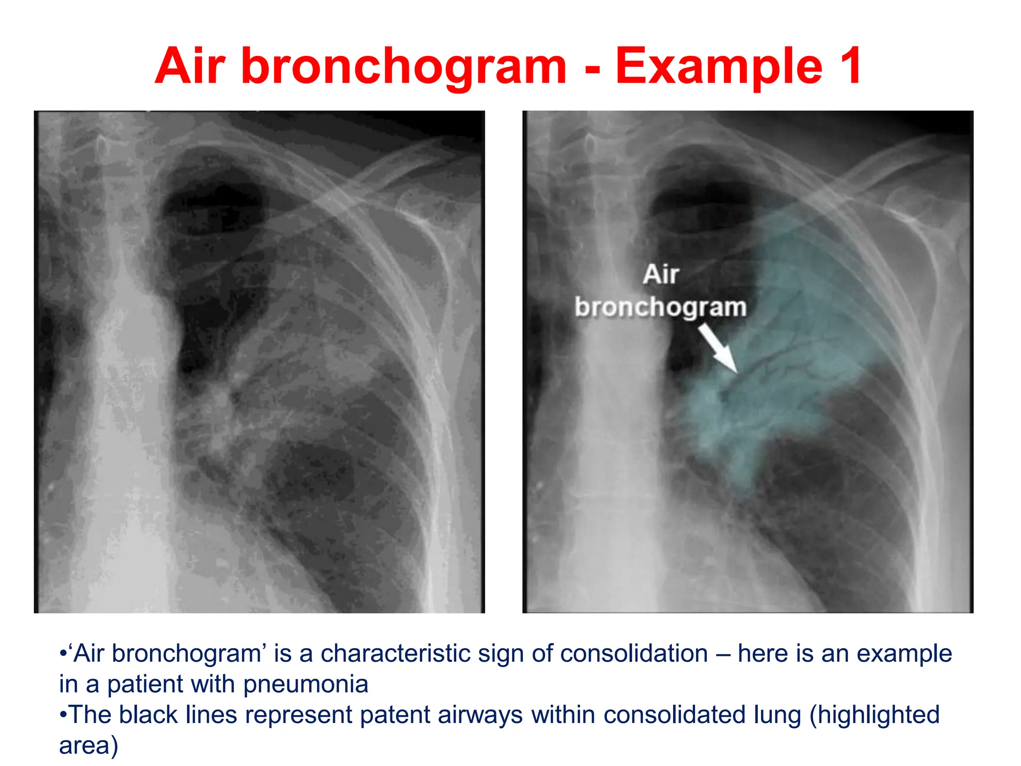 CHEST X-RAY PULMONARY DISEASE pptx.pptx