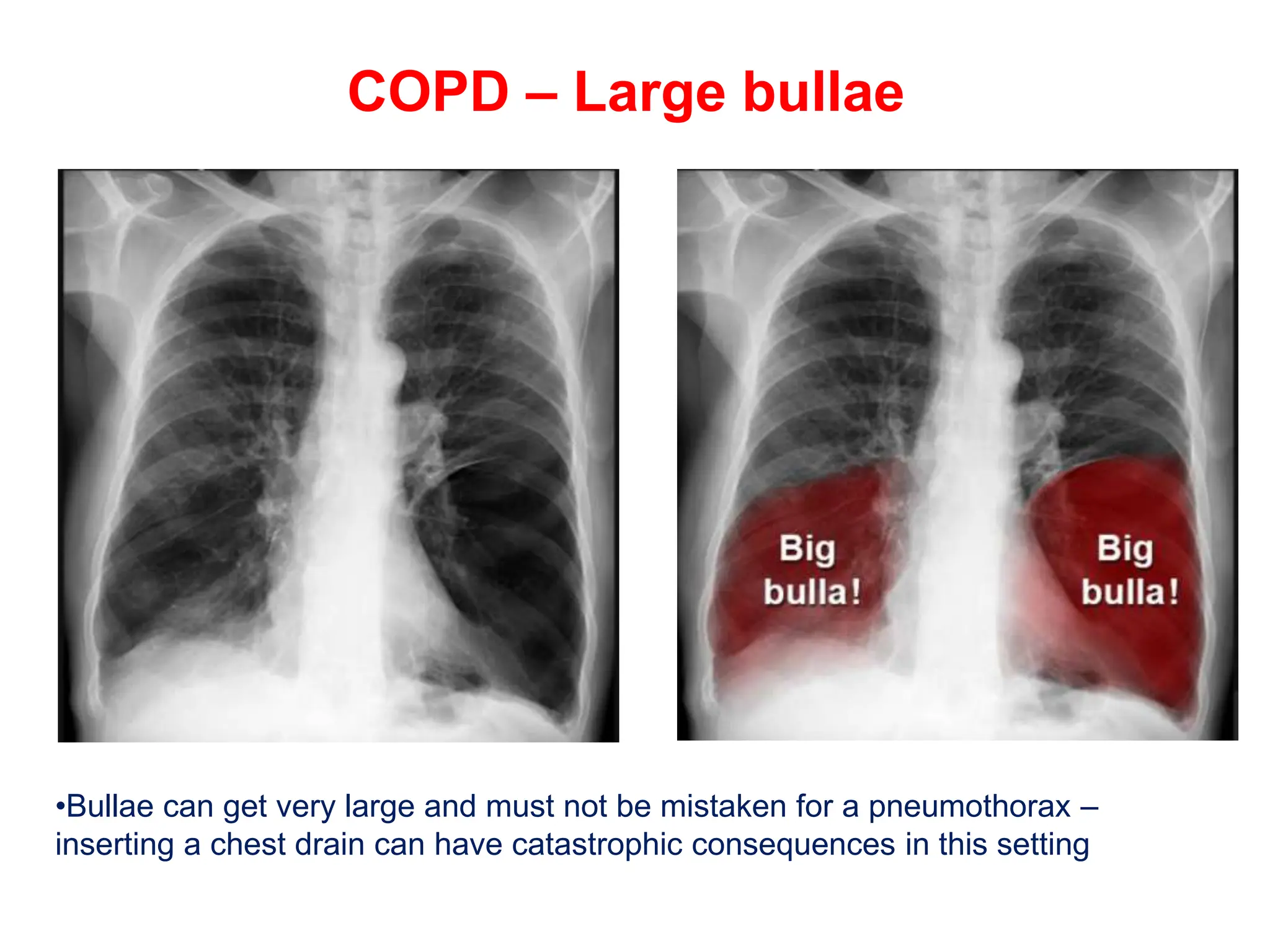 CHEST X-RAY PULMONARY DISEASE pptx.pptx