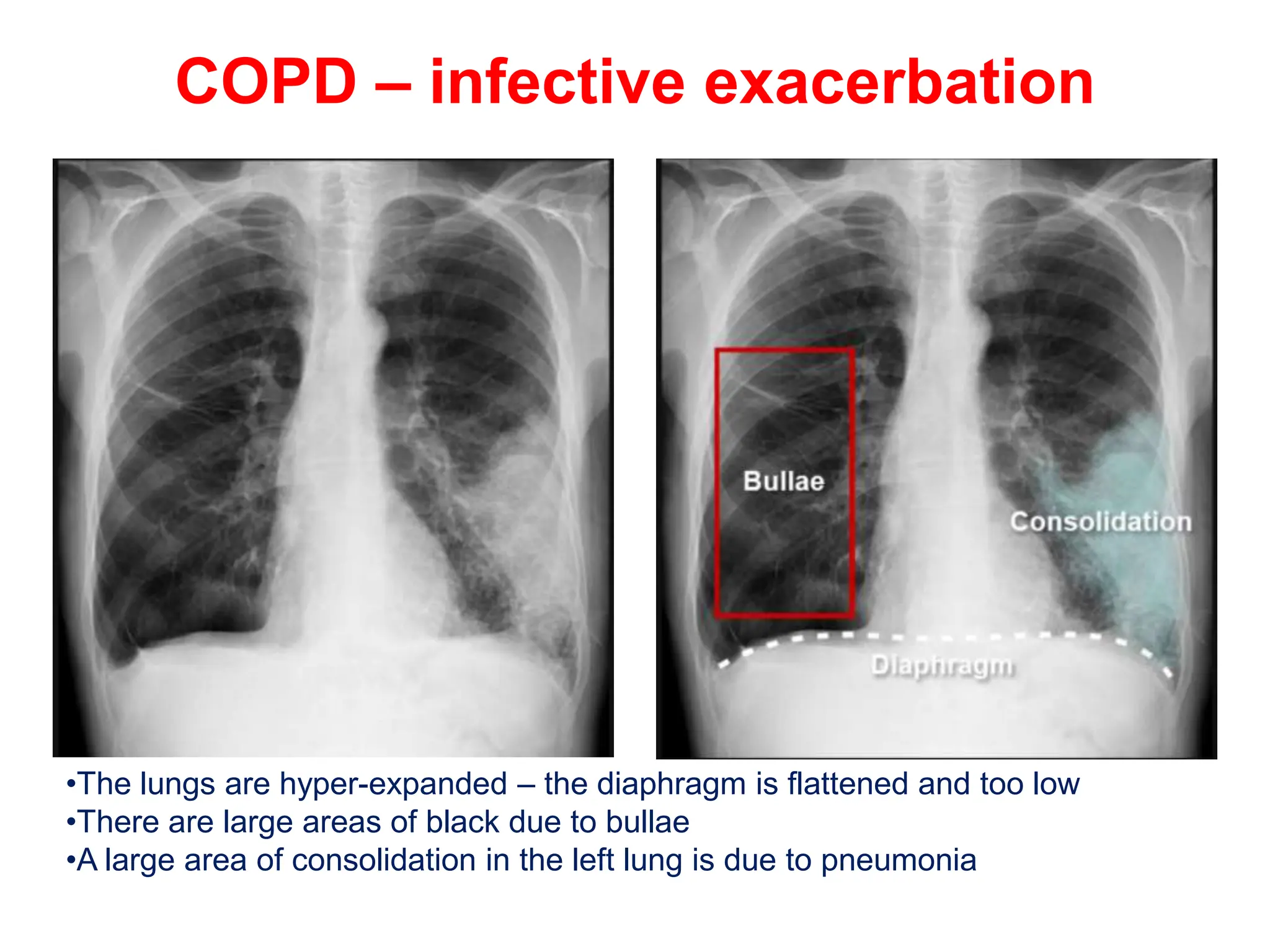 CHEST X-RAY PULMONARY DISEASE pptx.pptx