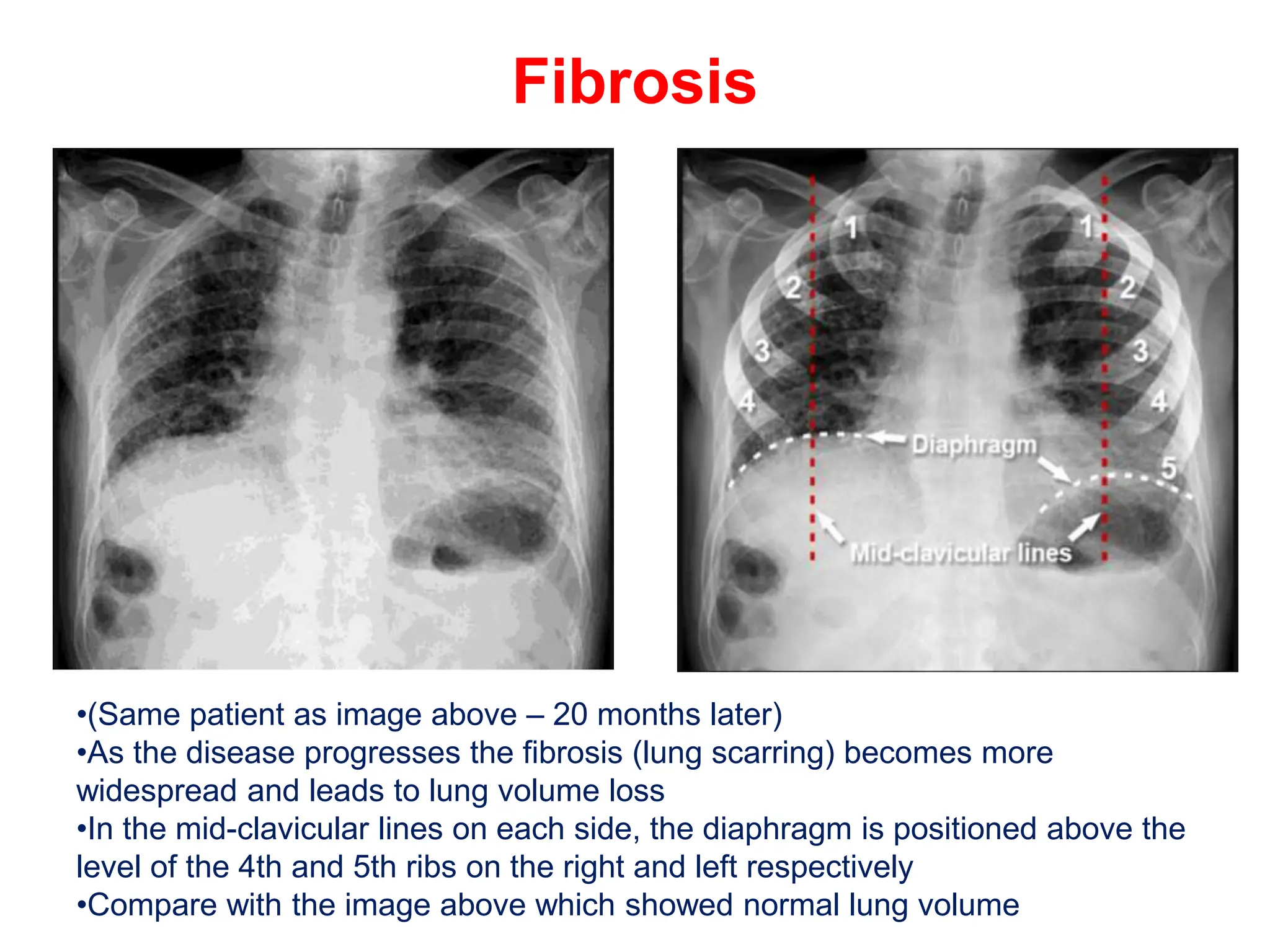 CHEST X-RAY PULMONARY DISEASE pptx.pptx