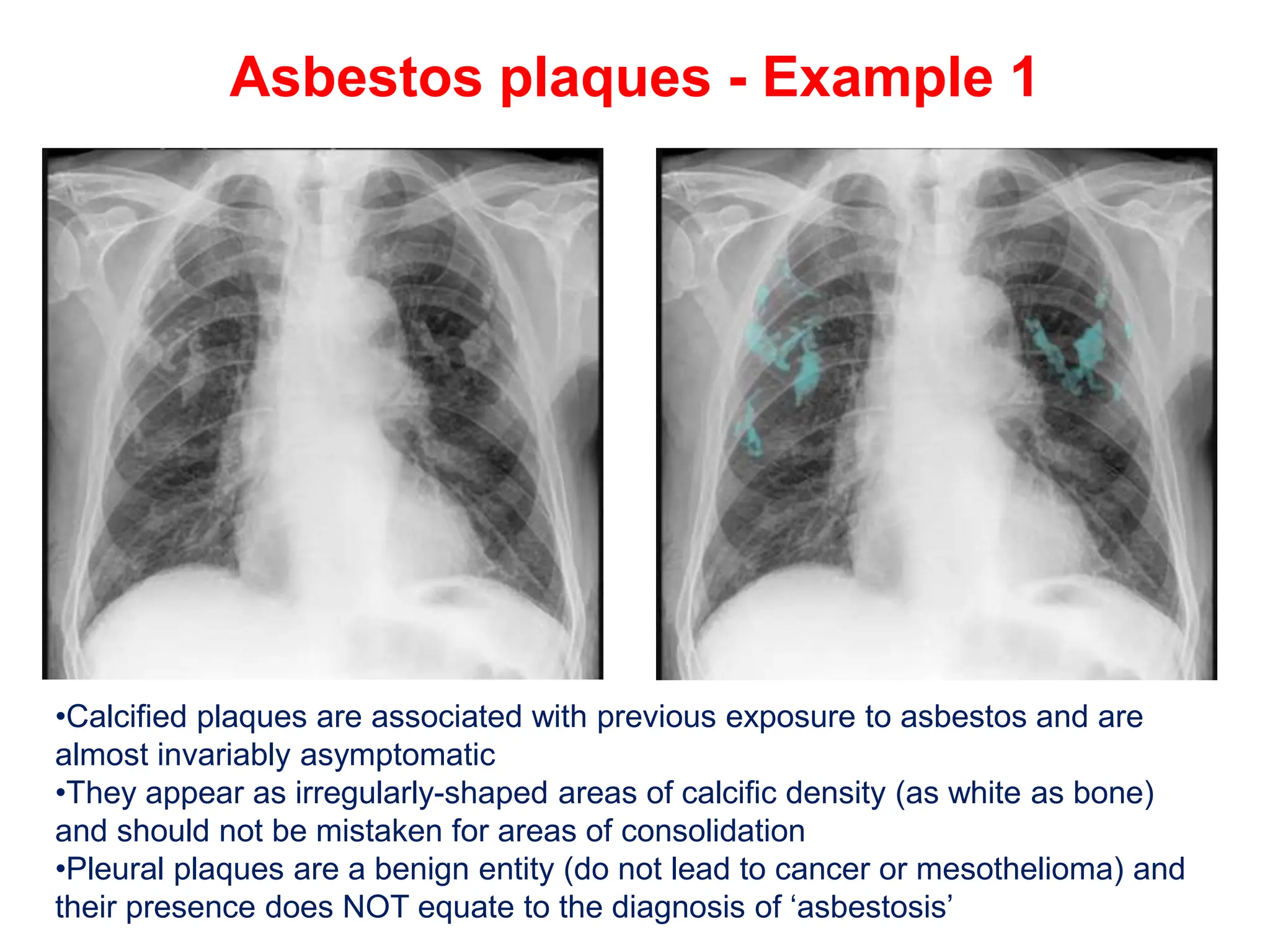 CHEST X-RAY PULMONARY DISEASE pptx.pptx