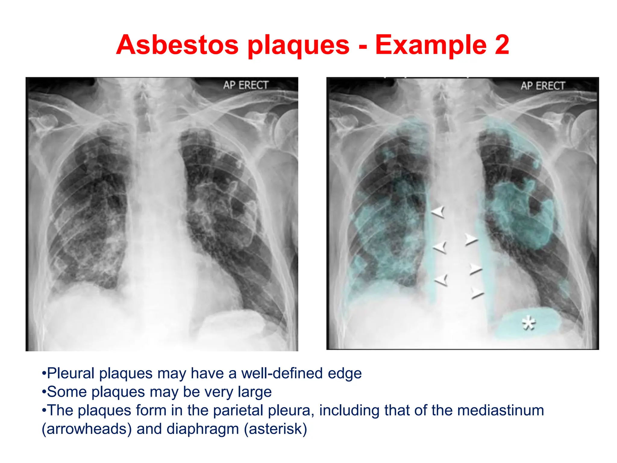 CHEST X-RAY PULMONARY DISEASE pptx.pptx