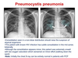 CHEST X-RAY PULMONARY DISEASE pptx.pptx