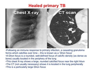 CHEST X-RAY PULMONARY DISEASE pptx.pptx