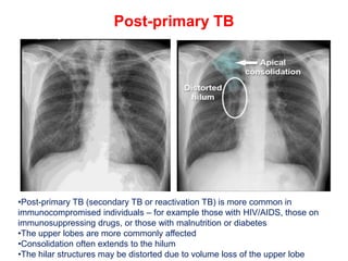 CHEST X-RAY PULMONARY DISEASE pptx.pptx