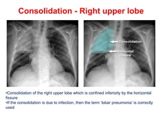 CHEST X-RAY PULMONARY DISEASE pptx.pptx