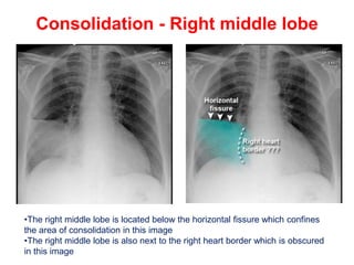 CHEST X-RAY PULMONARY DISEASE pptx.pptx