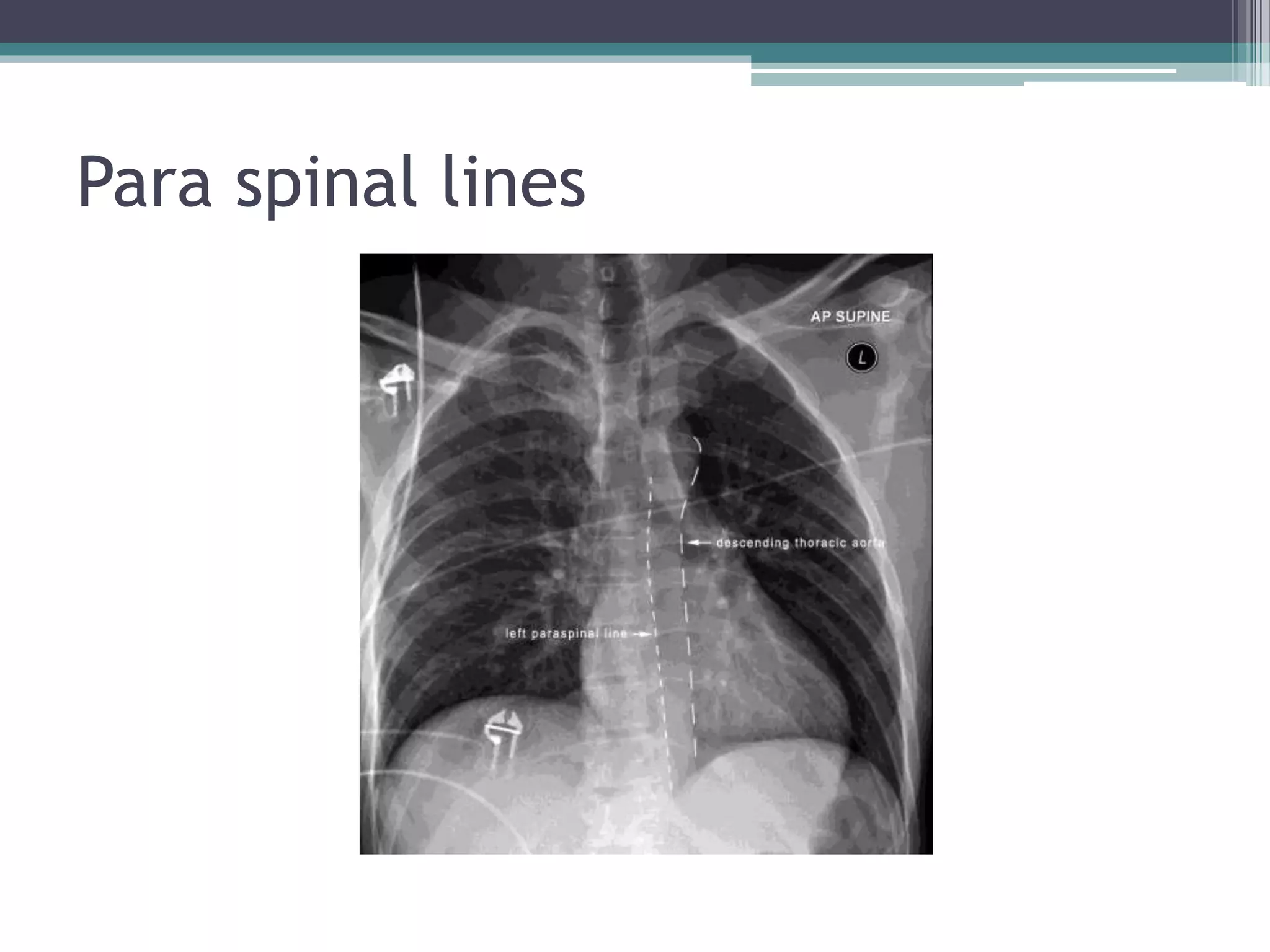 Chest x ray positioning | PPTX