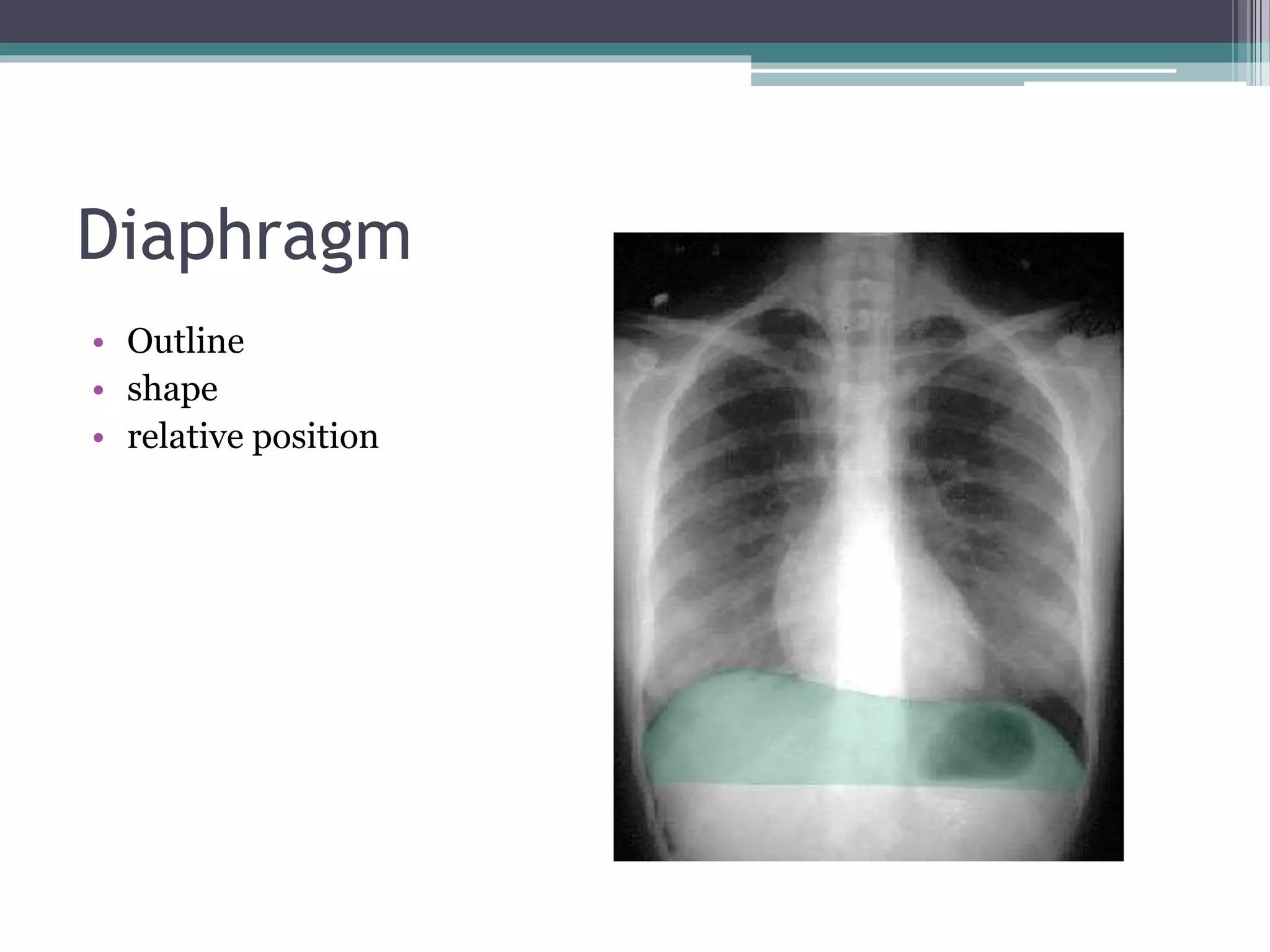 Chest x ray positioning | PPTX