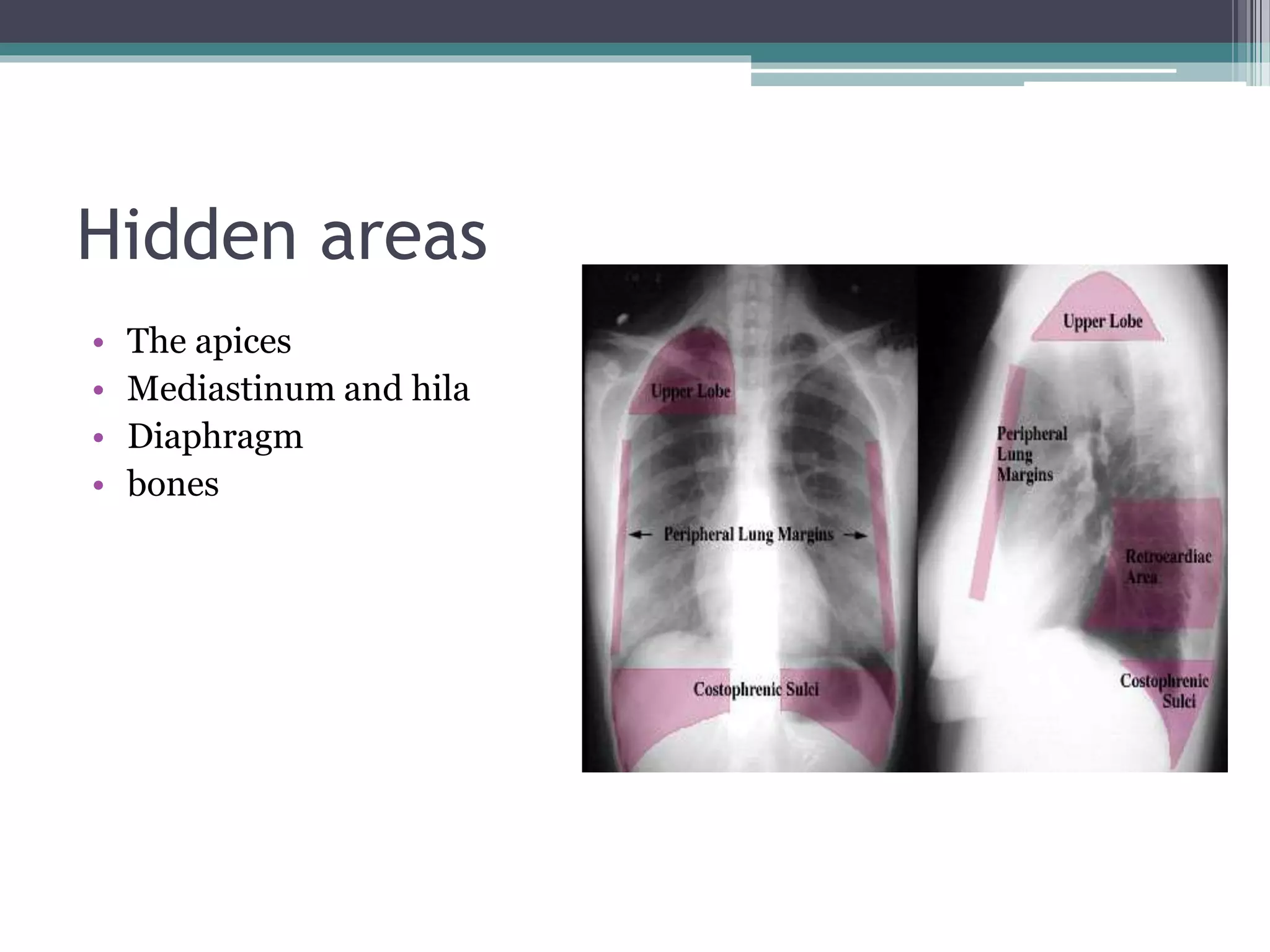 Chest x ray positioning | PPTX