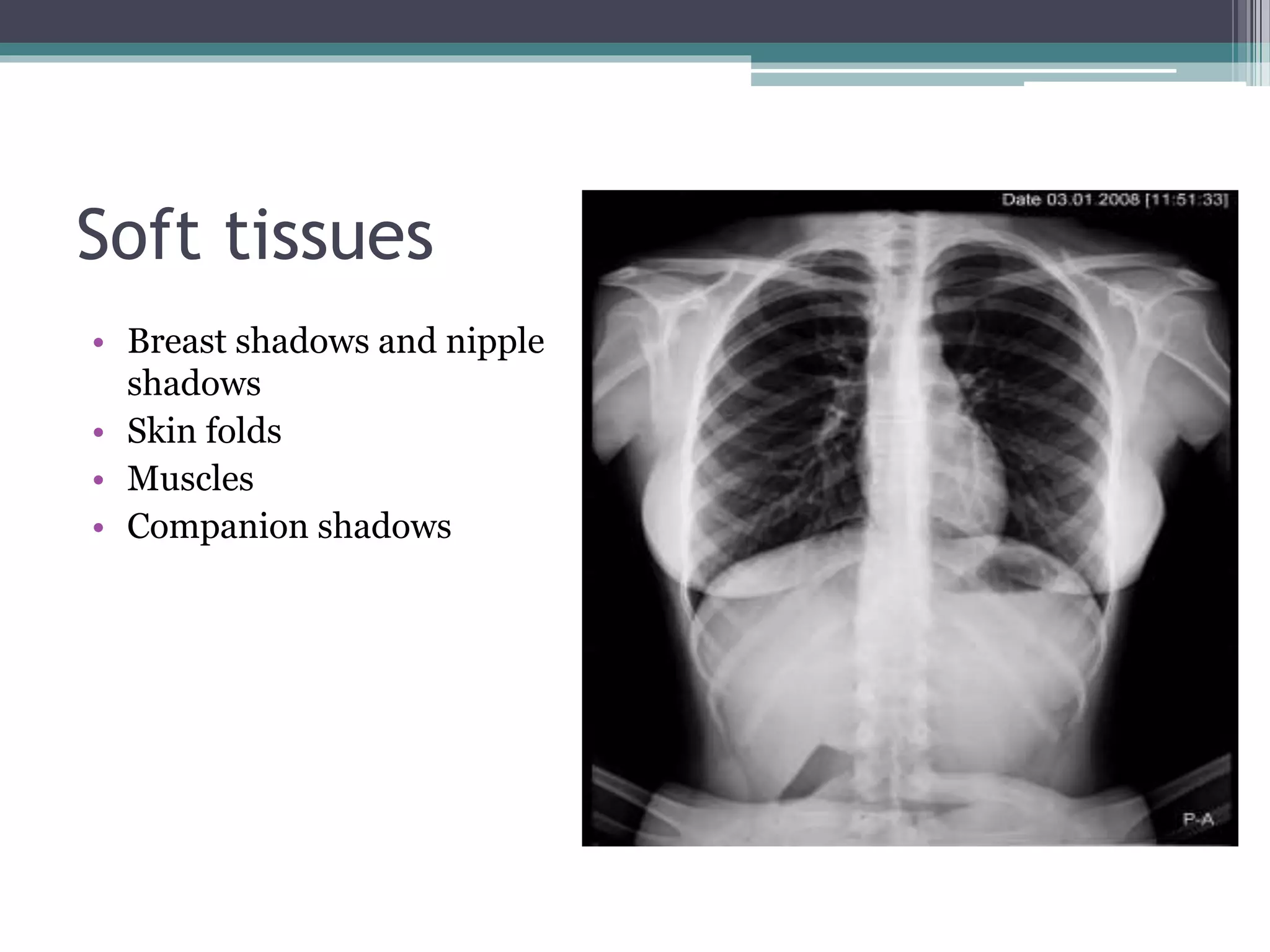 Chest x ray positioning | PPTX