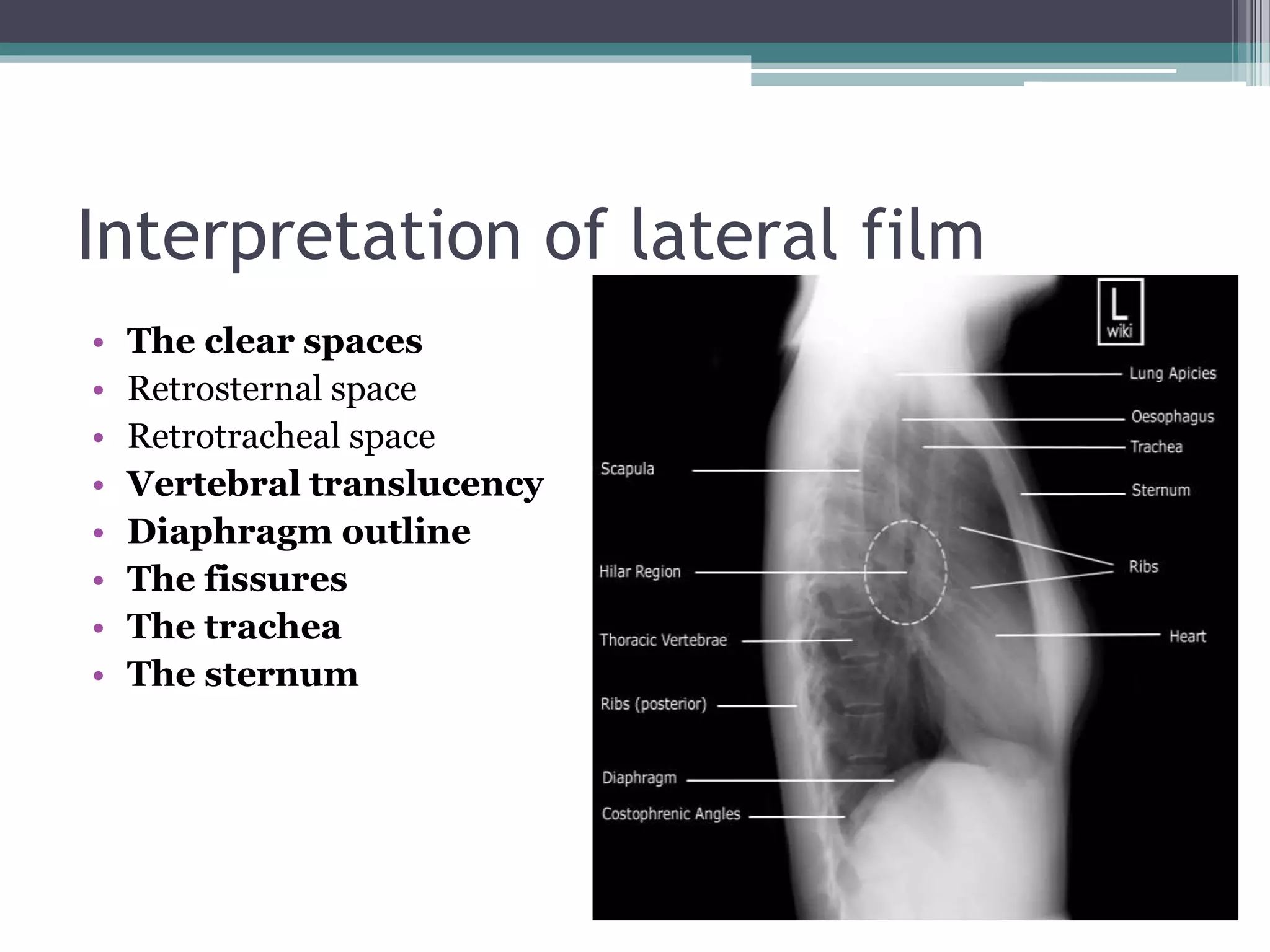 Chest x ray positioning | PPTX
