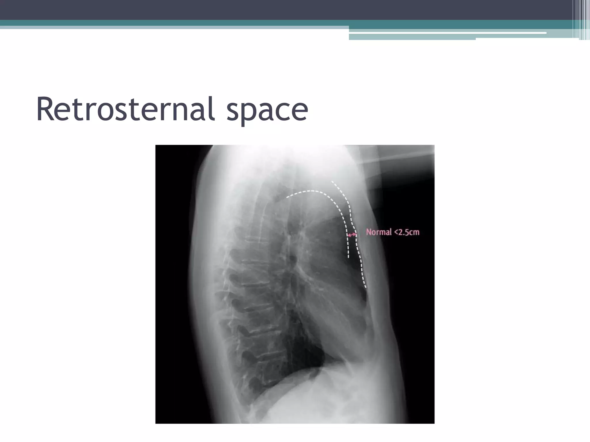Chest x ray positioning | PPTX