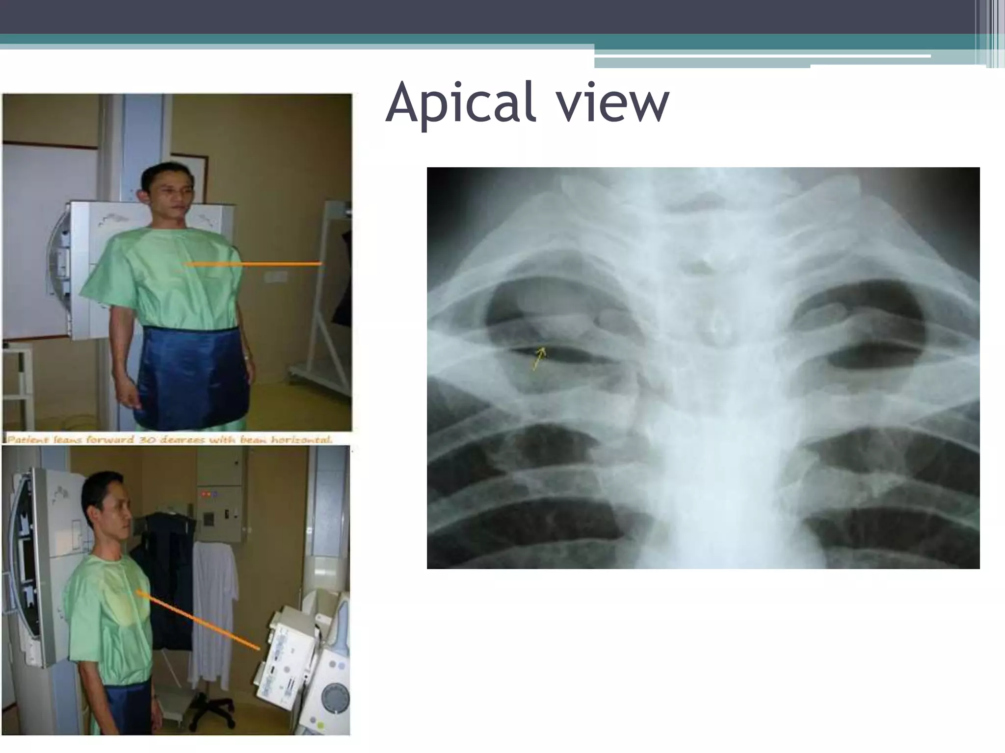 Chest x ray positioning | PPTX
