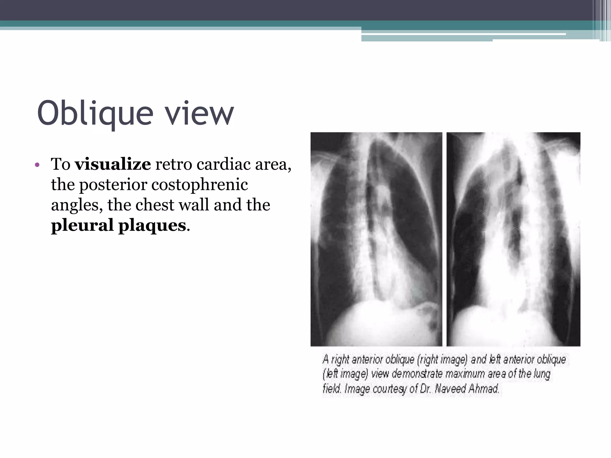 Chest x ray positioning | PPTX