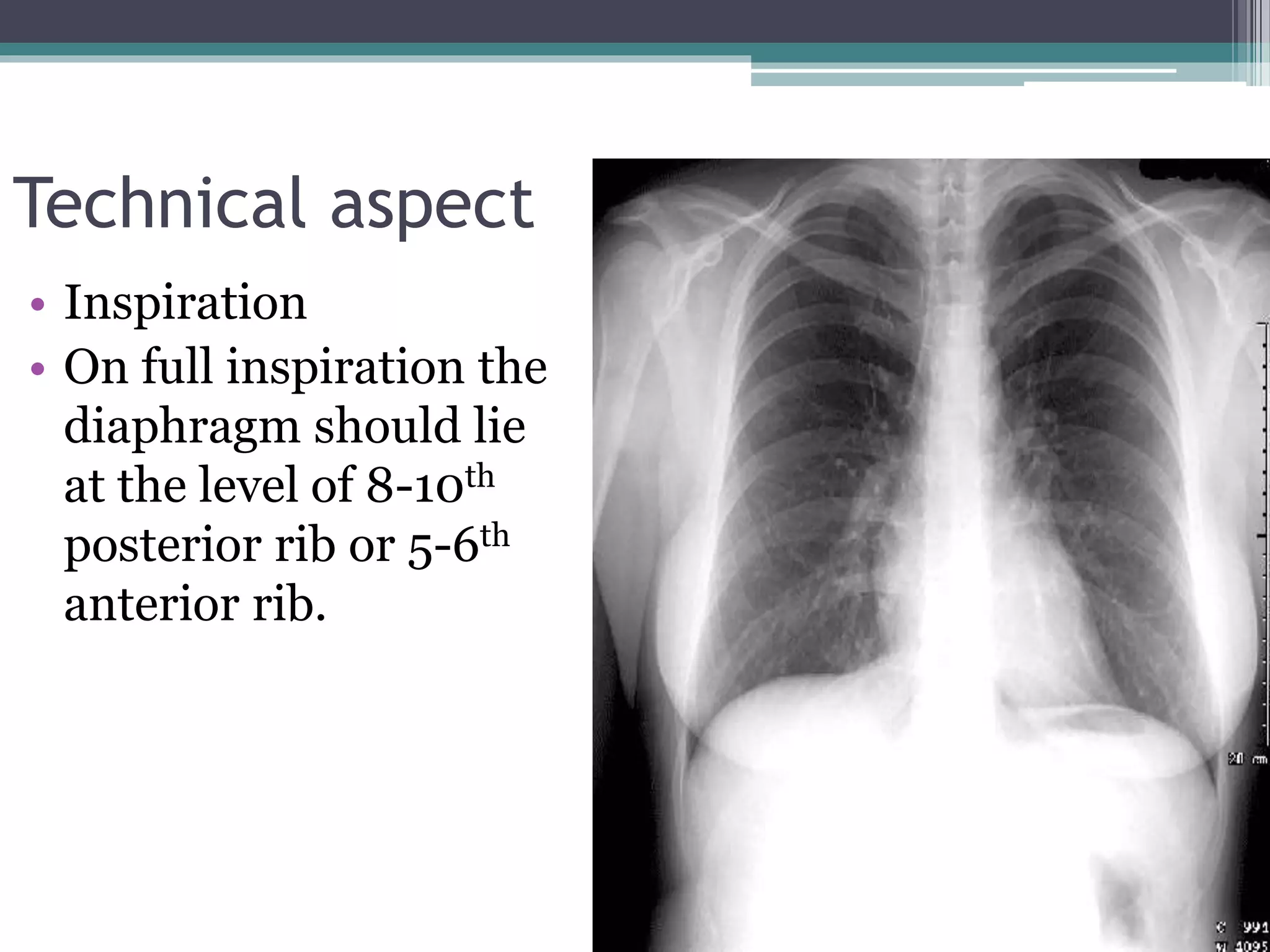 Chest x ray positioning | PPTX