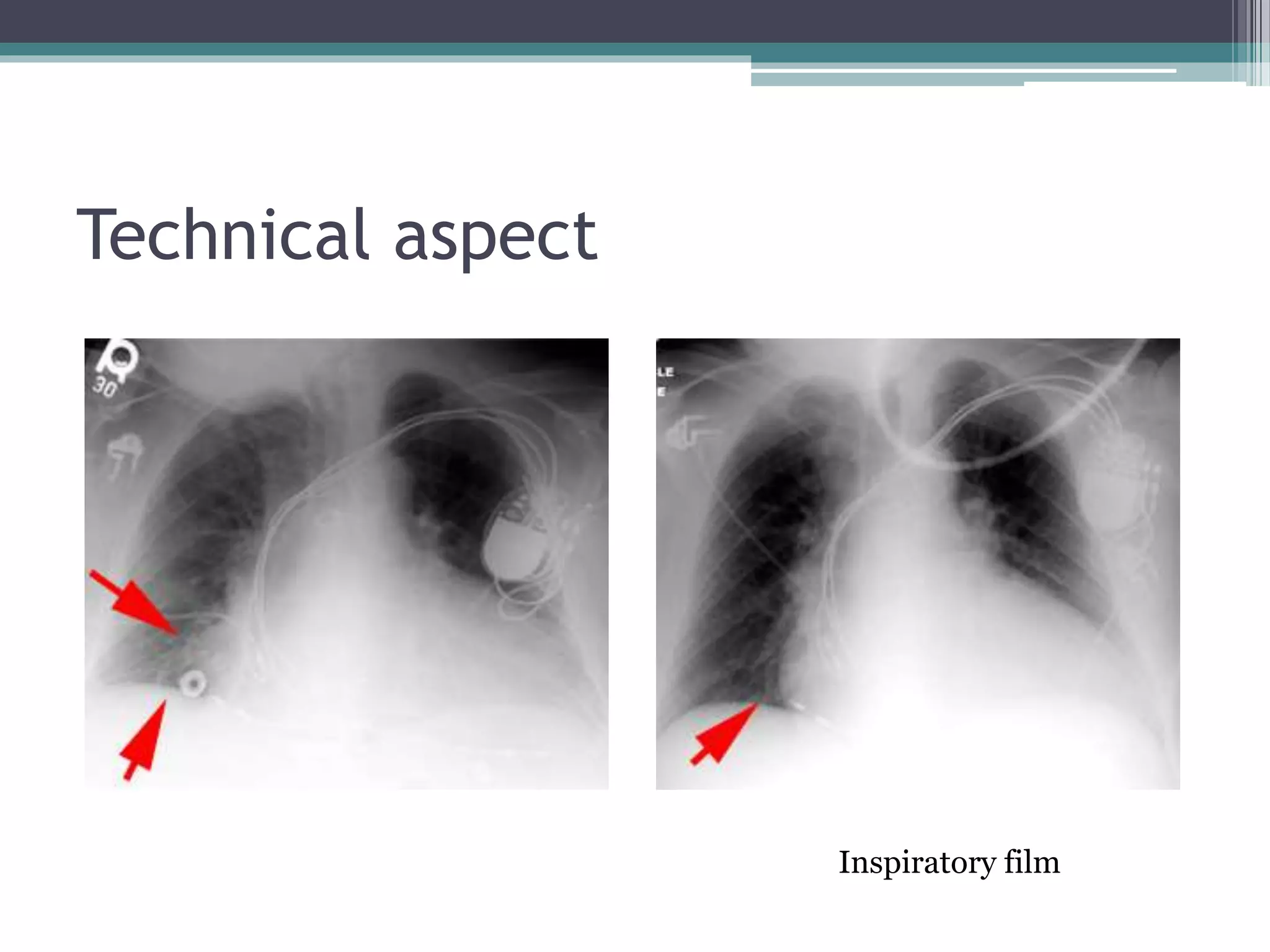 Chest x ray positioning | PPTX