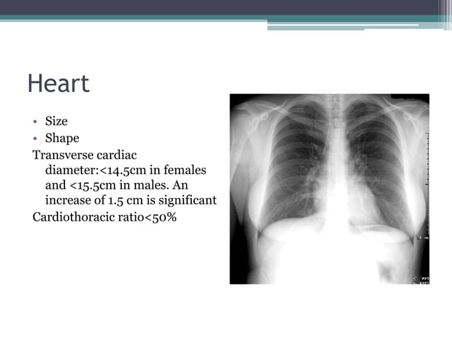 Chest x ray positioning | PPTX | Lung and Respiratory Health | Diseases ...