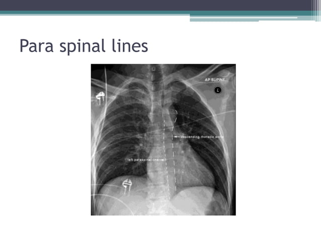 Chest x ray positioning | PPTX | Lung and Respiratory Health | Diseases ...