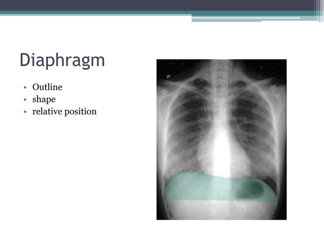 Chest x ray positioning | PPTX | Lung and Respiratory Health | Diseases ...