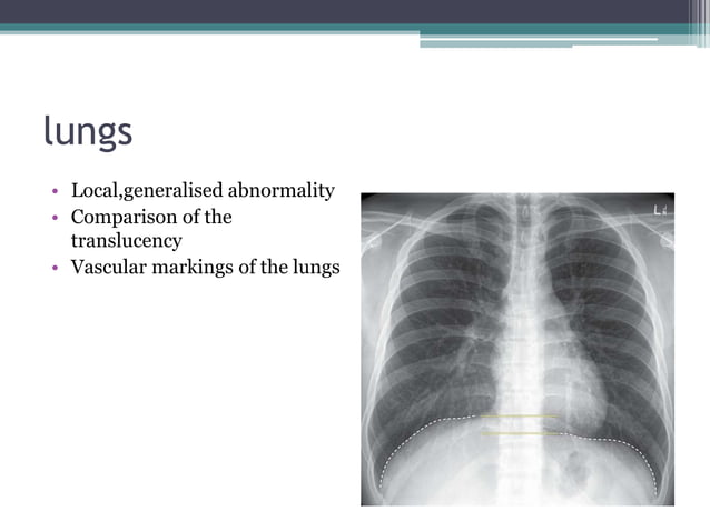 Chest x ray positioning | PPTX | Lung and Respiratory Health | Diseases ...