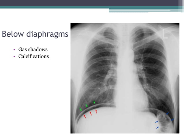 Chest x ray positioning | PPTX | Lung and Respiratory Health | Diseases ...