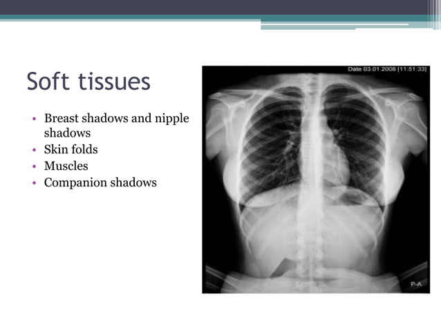 Chest x ray positioning | PPTX | Lung and Respiratory Health | Diseases ...