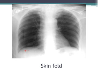Chest x ray positioning | PPTX