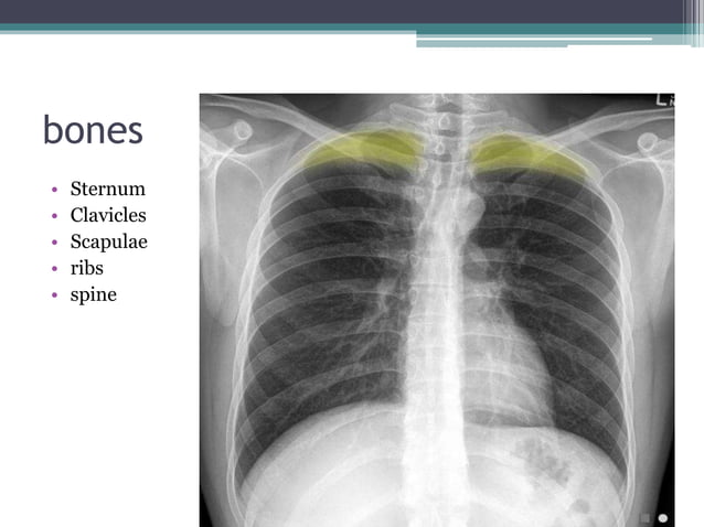 Chest x ray positioning | PPTX | Lung and Respiratory Health | Diseases ...