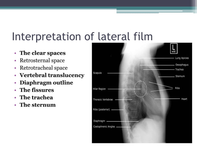 Chest x ray positioning | PPTX | Lung and Respiratory Health | Diseases ...